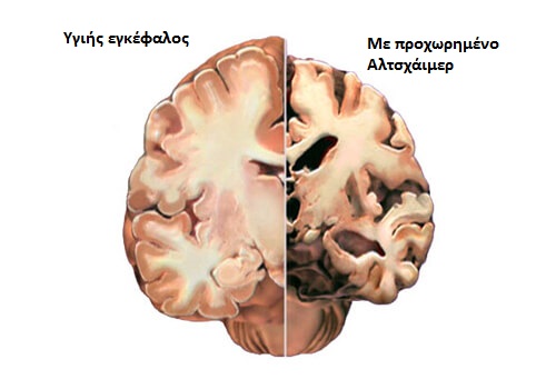 Νόσος Αλτσχάιμερ: Ανιχνεύστε έγκαιρα τα πρώτα σημάδια - Με Υγεία